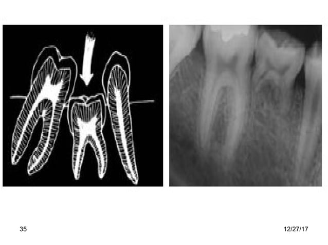 tooth Morphology central incisor | PPT
