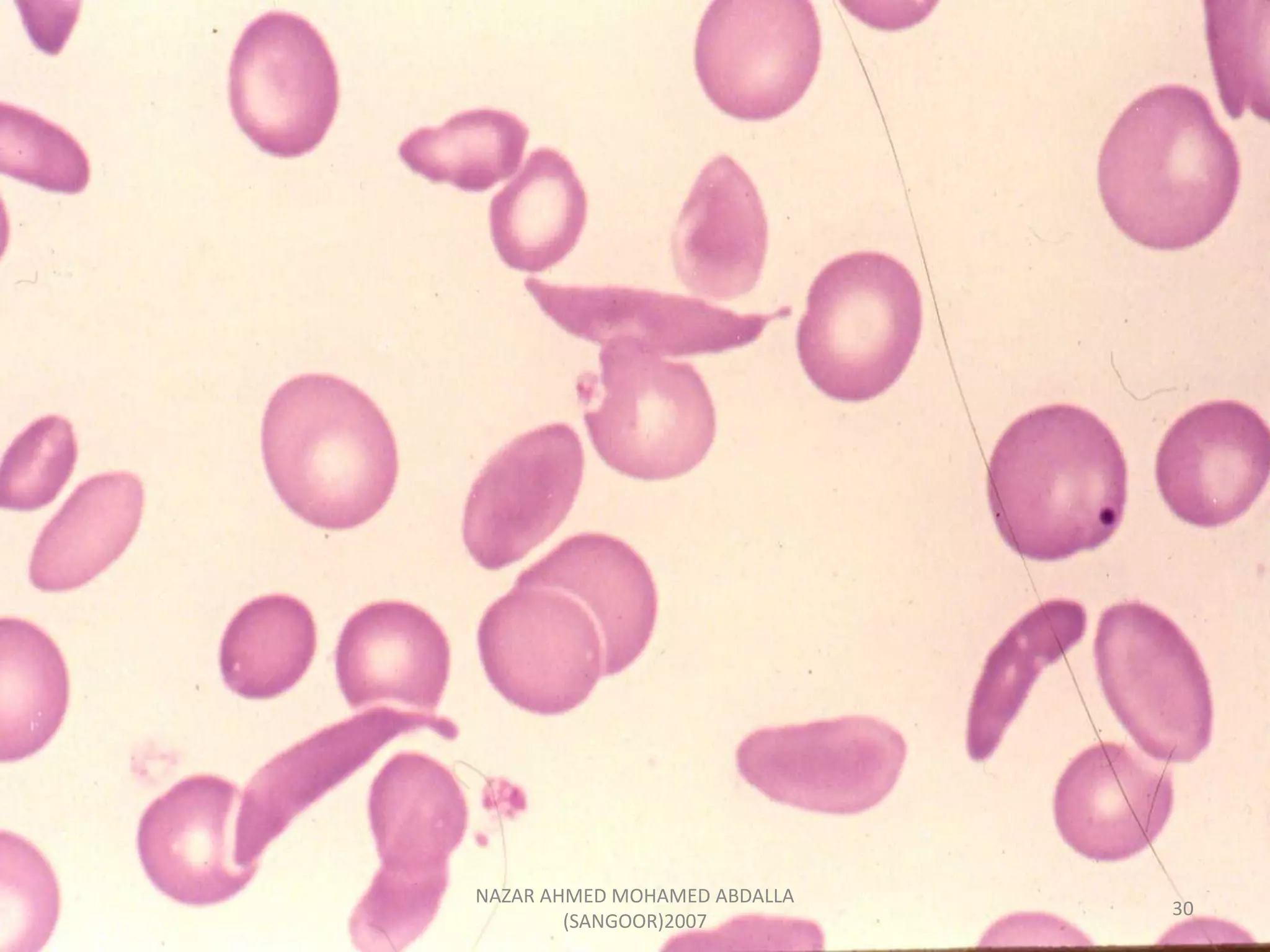 Morphological abnormality of red blood cell | PDF