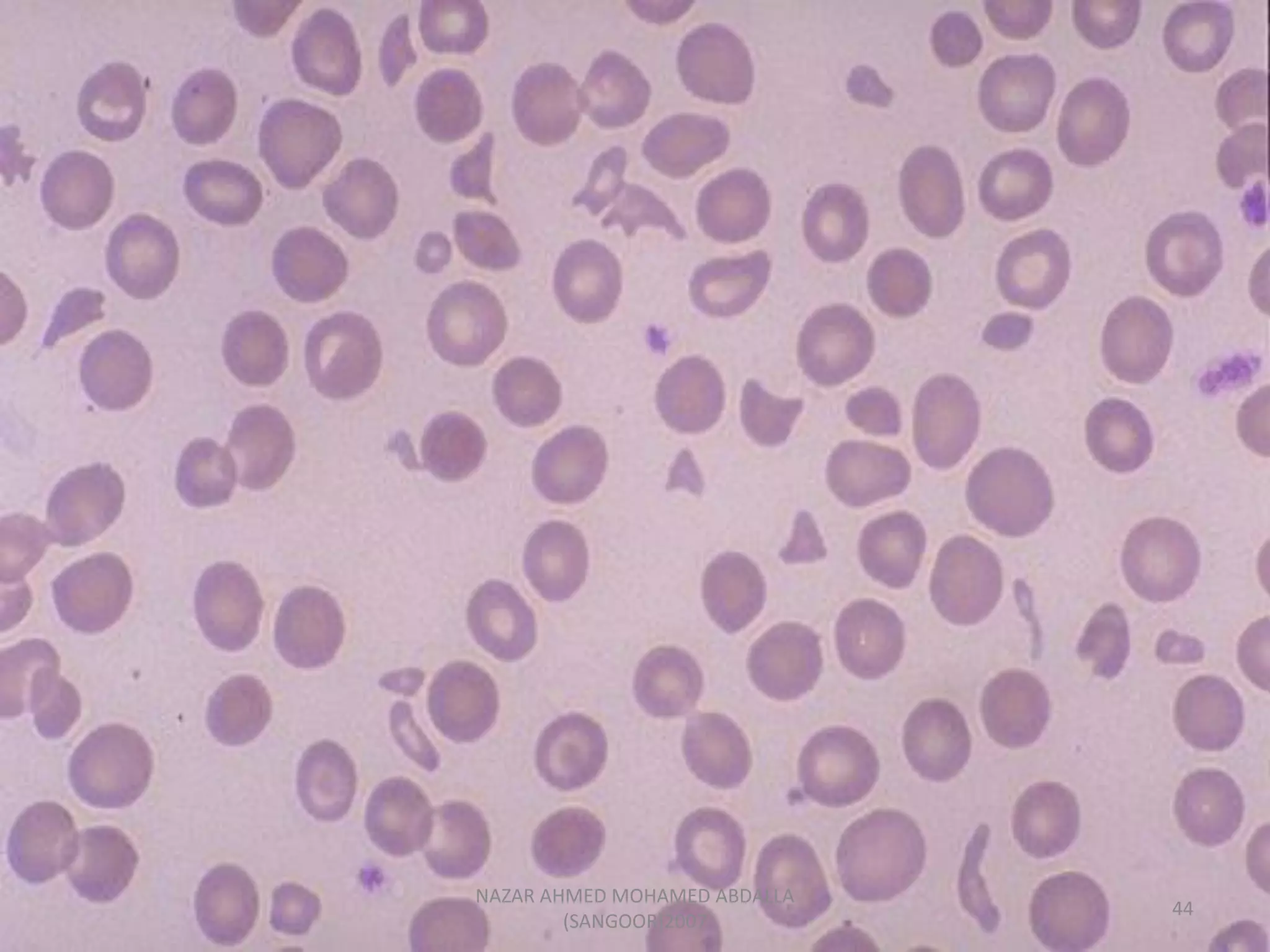 Morphological abnormality of red blood cell | PDF