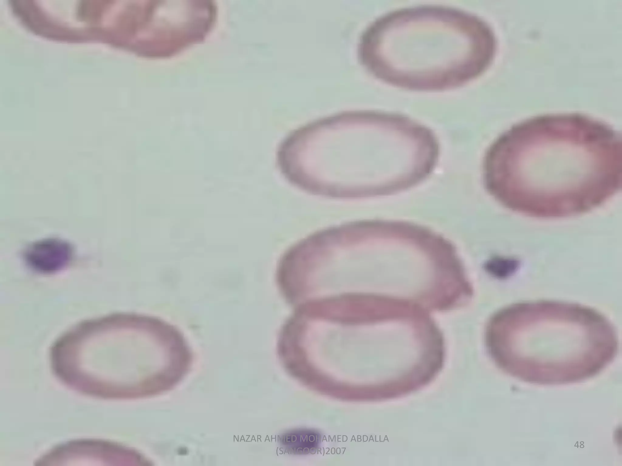 Morphological abnormality of red blood cell | PDF