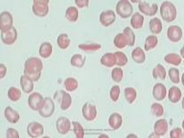 Morphological abnormality of red blood cell | PDF