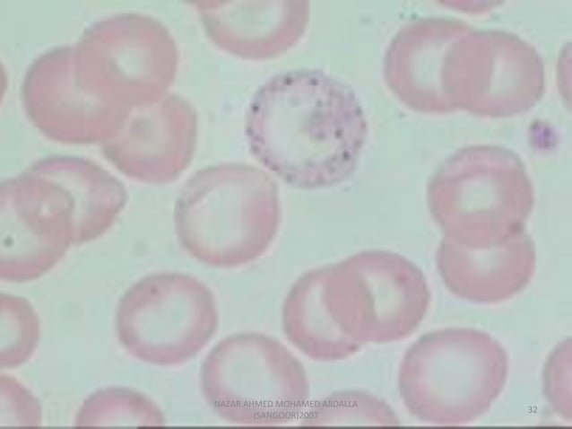 Morphological abnormality of red blood cell | PDF