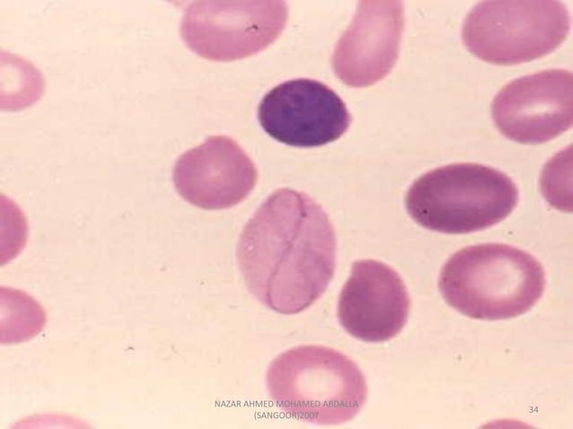 Morphological abnormality of red blood cell | PDF