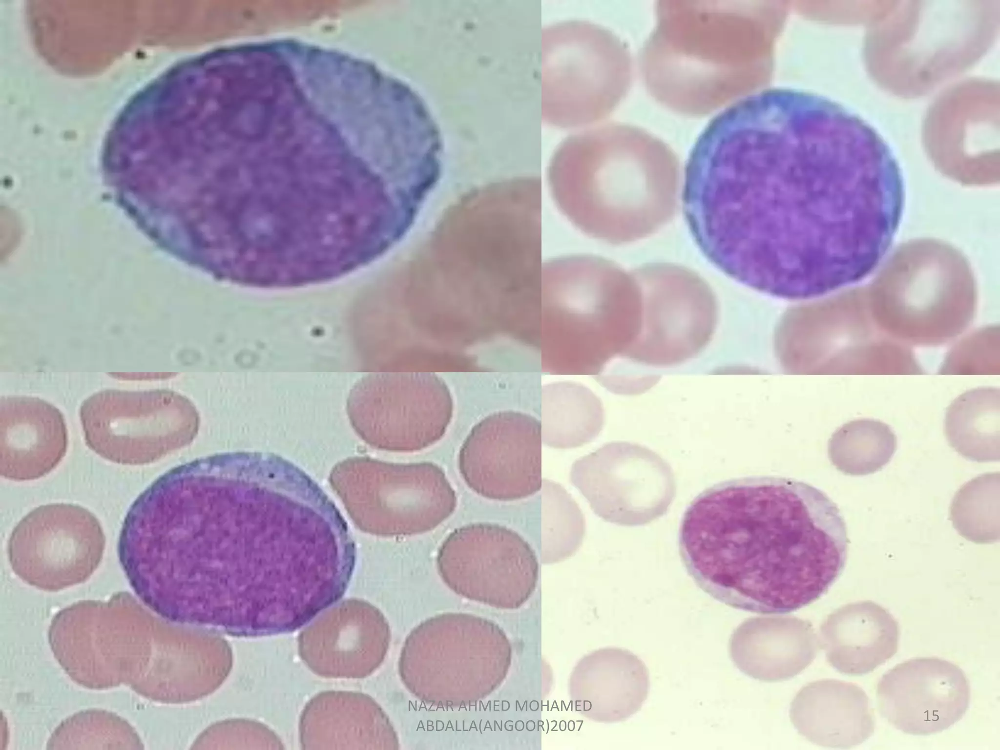Morphological abnormality of white blood cell | PDF | Blood Disorders ...