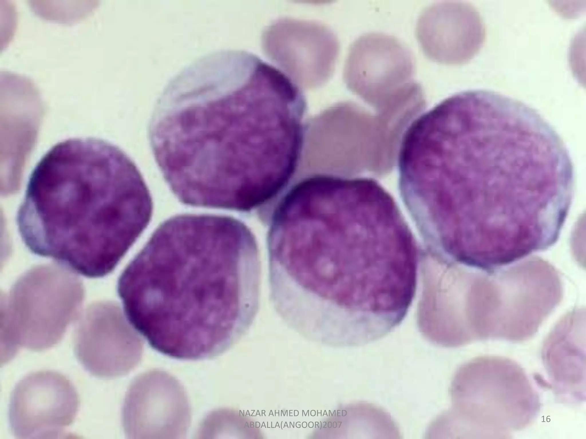 Morphological abnormality of white blood cell | PDF | Blood Disorders ...