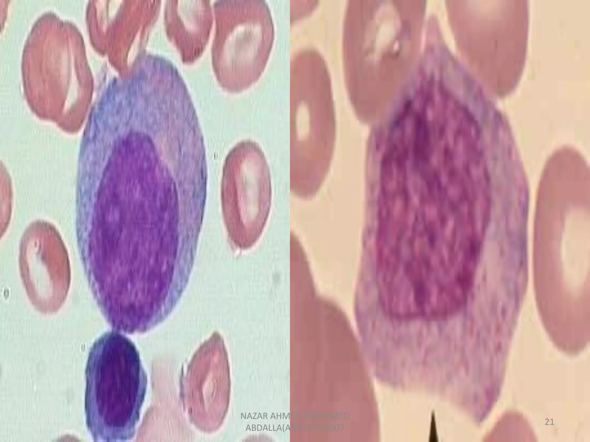Morphological abnormality of white blood cell | PDF | Blood Disorders ...