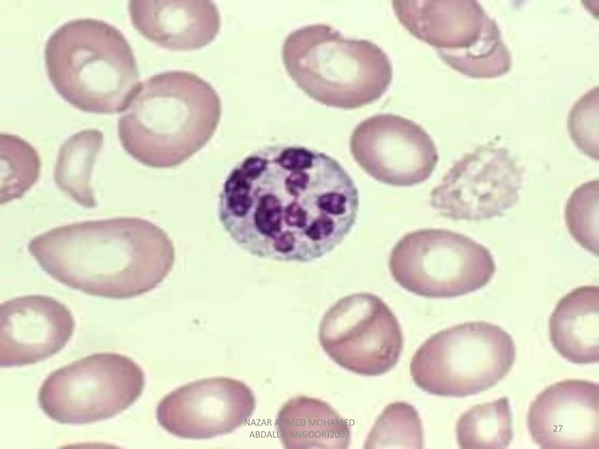 Morphological abnormality of white blood cell | PDF | Blood Disorders ...