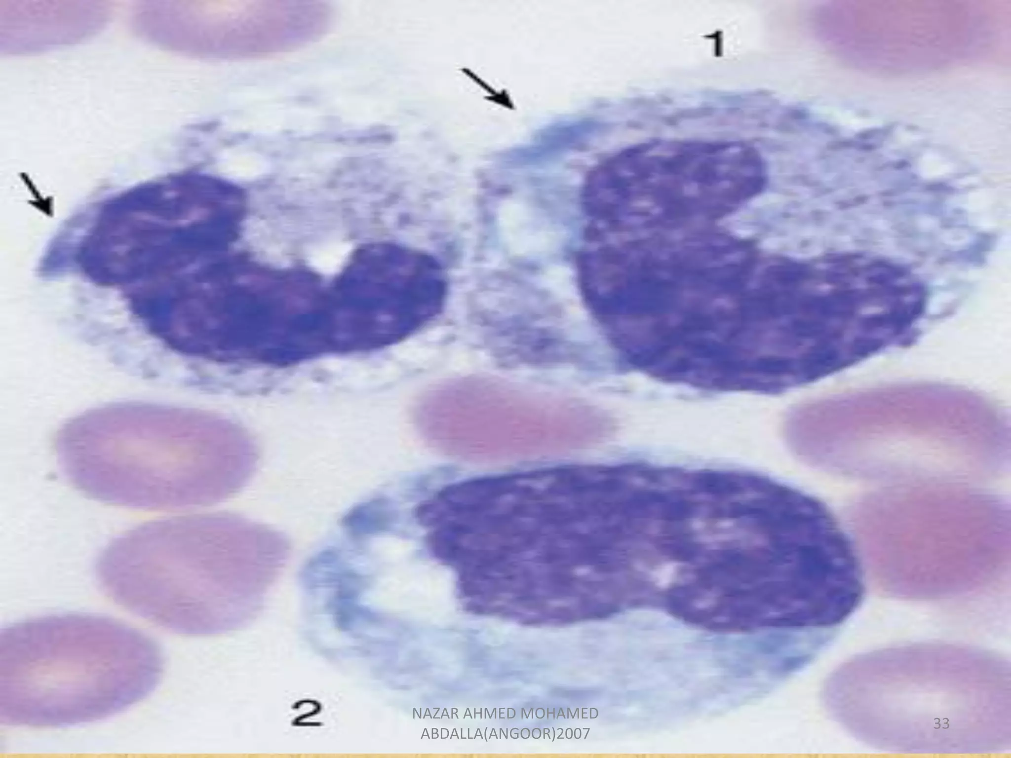 Morphological abnormality of white blood cell | PDF