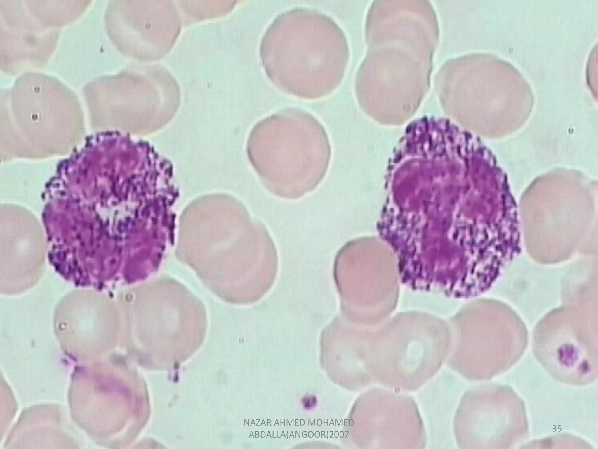 Morphological abnormality of white blood cell | PDF | Blood Disorders ...