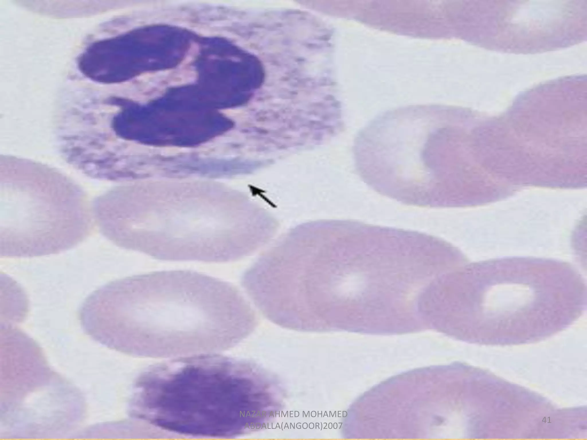 Morphological abnormality of white blood cell | PDF