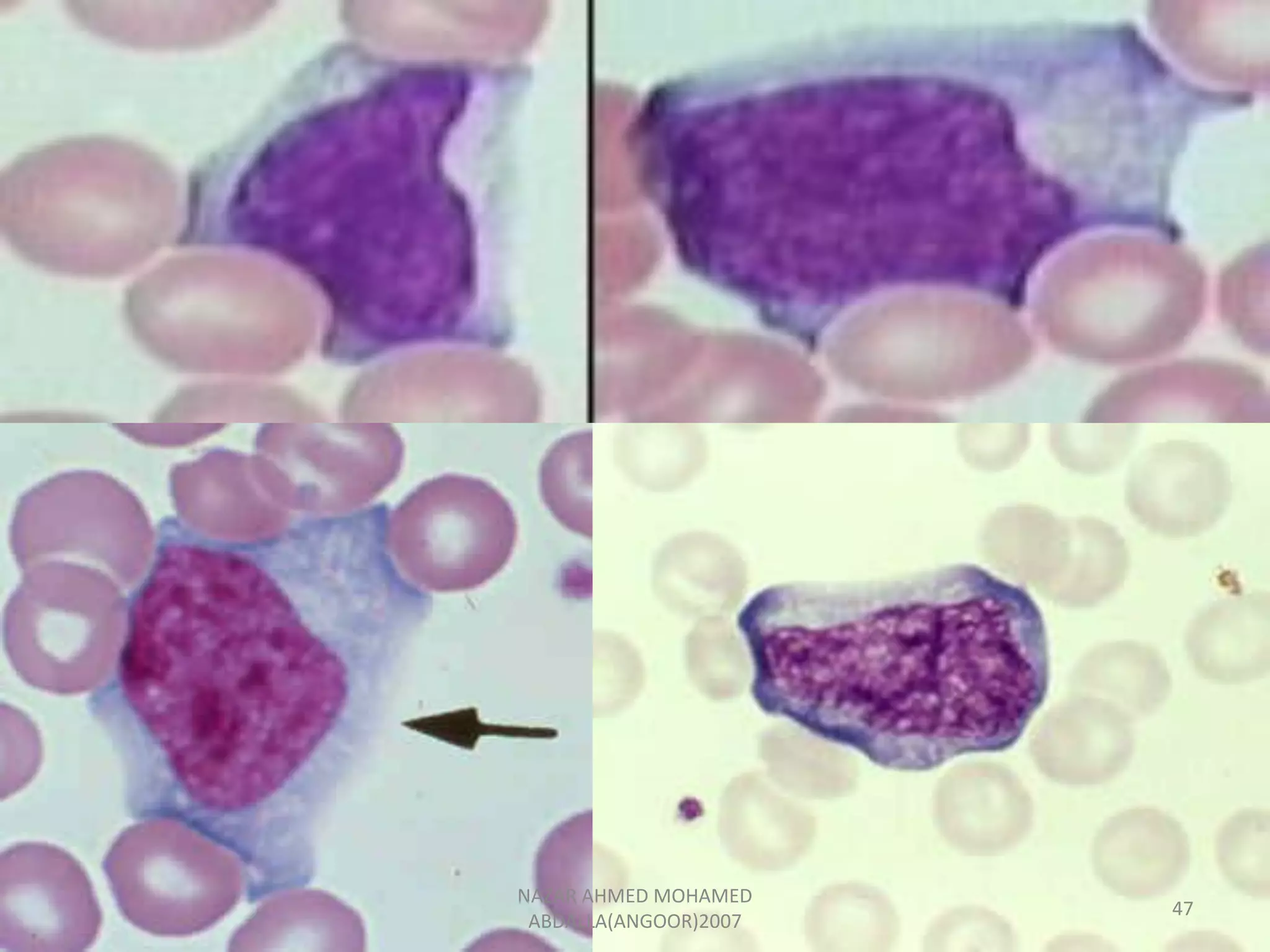 Morphological abnormality of white blood cell | PDF