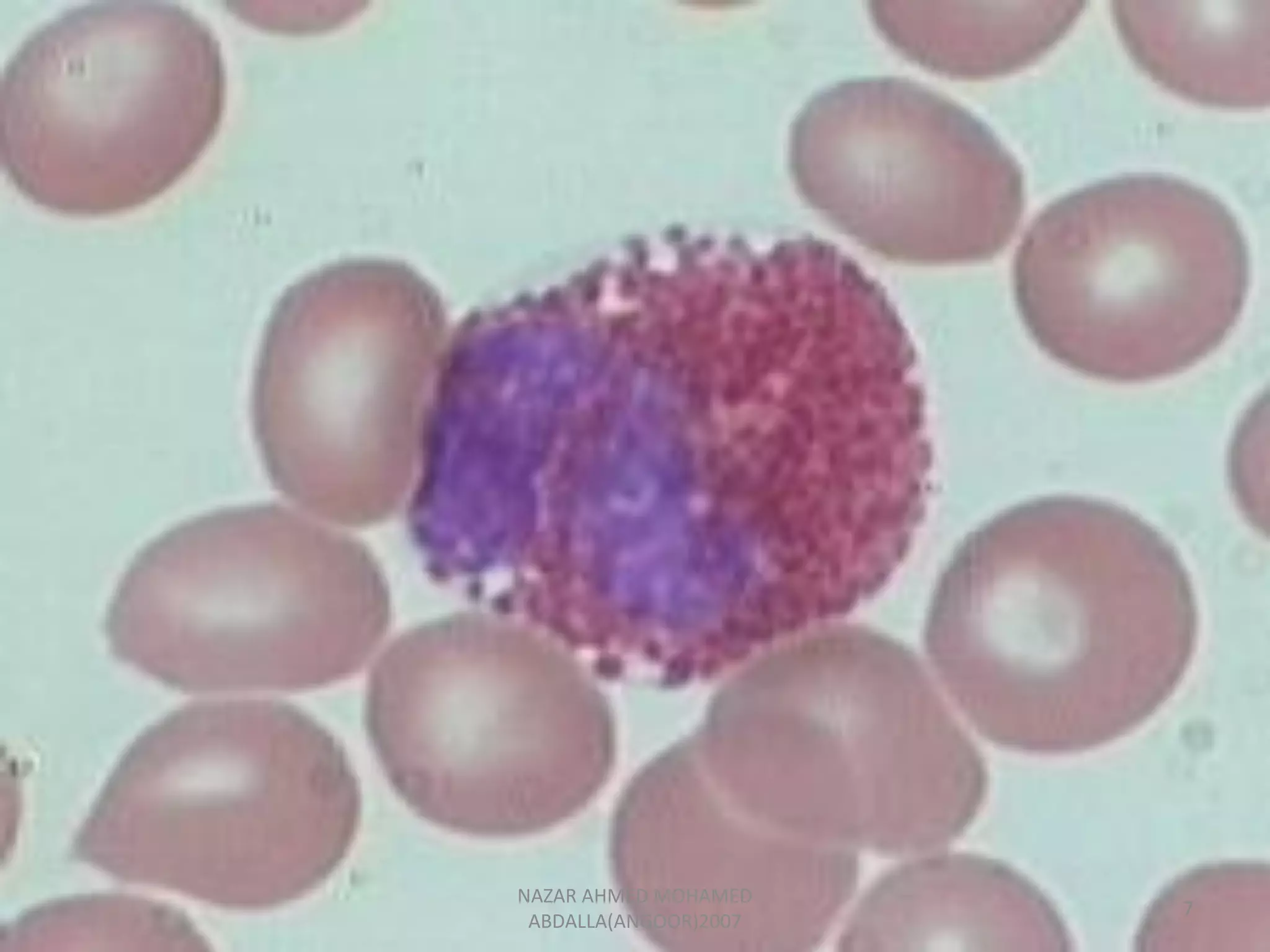 Morphological abnormality of white blood cell | PDF