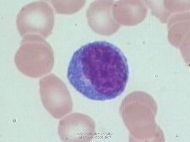 Morphological abnormality of white blood cell | PDF | Blood Disorders ...