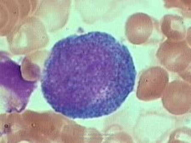 Morphological abnormality of white blood cell | PDF | Blood Disorders ...