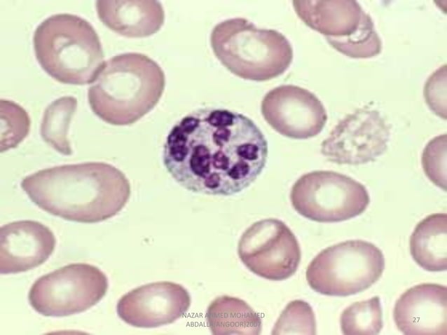 Morphological abnormality of white blood cell | PDF | Blood Disorders ...
