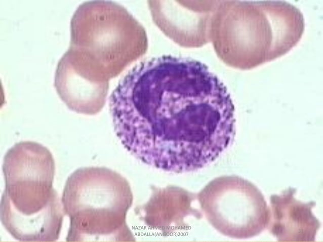 Morphological abnormality of white blood cell | PDF | Blood Disorders ...