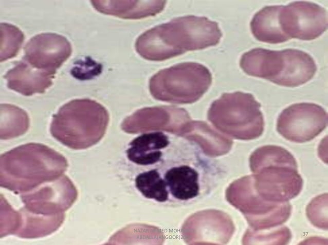 Morphological abnormality of white blood cell | PDF | Blood Disorders ...