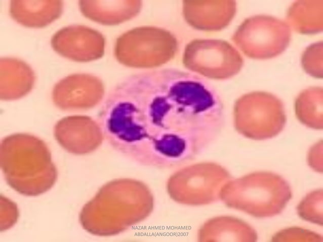 Morphological abnormality of white blood cell | PDF | Blood Disorders ...