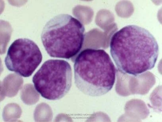 Morphological abnormality of white blood cell