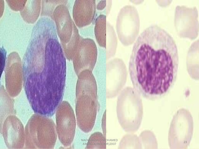 Morphological abnormality of white blood cell
