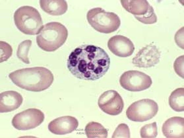 Morphological abnormality of white blood cell