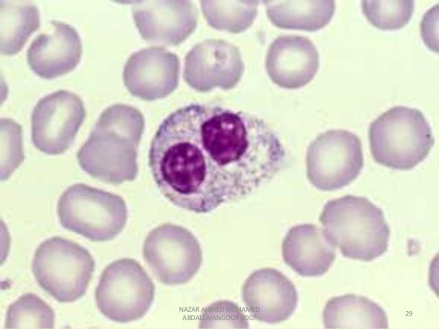 Morphological abnormality of white blood cell