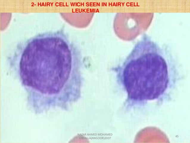 Morphological abnormality of white blood cell