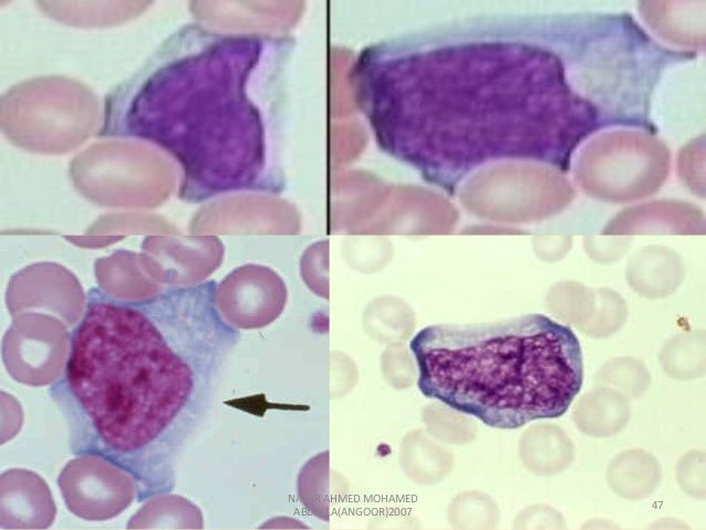 Morphological abnormality of white blood cell