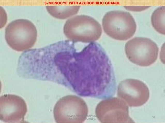Morphological abnormality of white blood cell