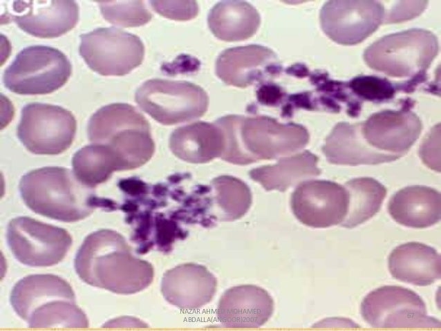 Morphological abnormality of white blood cell