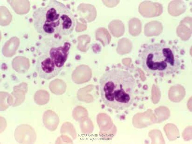 Morphological abnormality of white blood cell