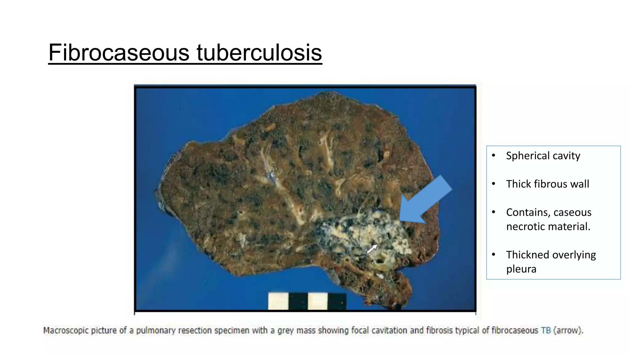 Morphological features of tuberculosis | PPTX