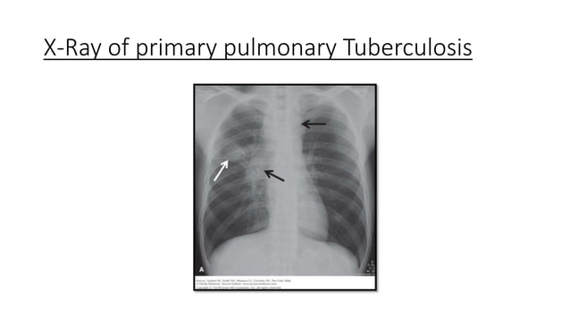 Morphological features of tuberculosis | PPTX | Digestive Disorders ...