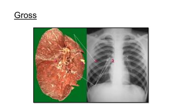 Morphological features of tuberculosis | PPTX | Digestive Disorders ...