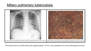Morphological features of tuberculosis | PPTX