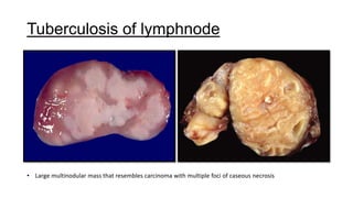 Morphological features of tuberculosis | PPTX