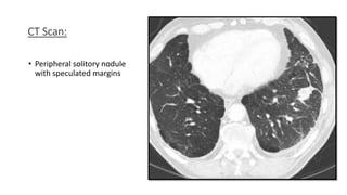 Morphological features of tuberculosis | PPTX