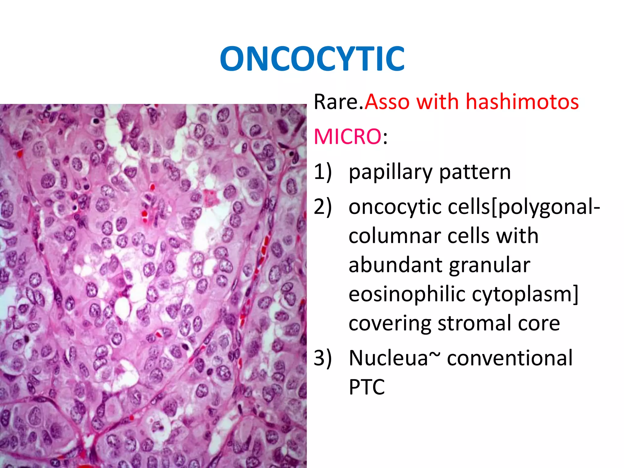 Morphological spectrum of malignant thyroid neoplasm | PPTX