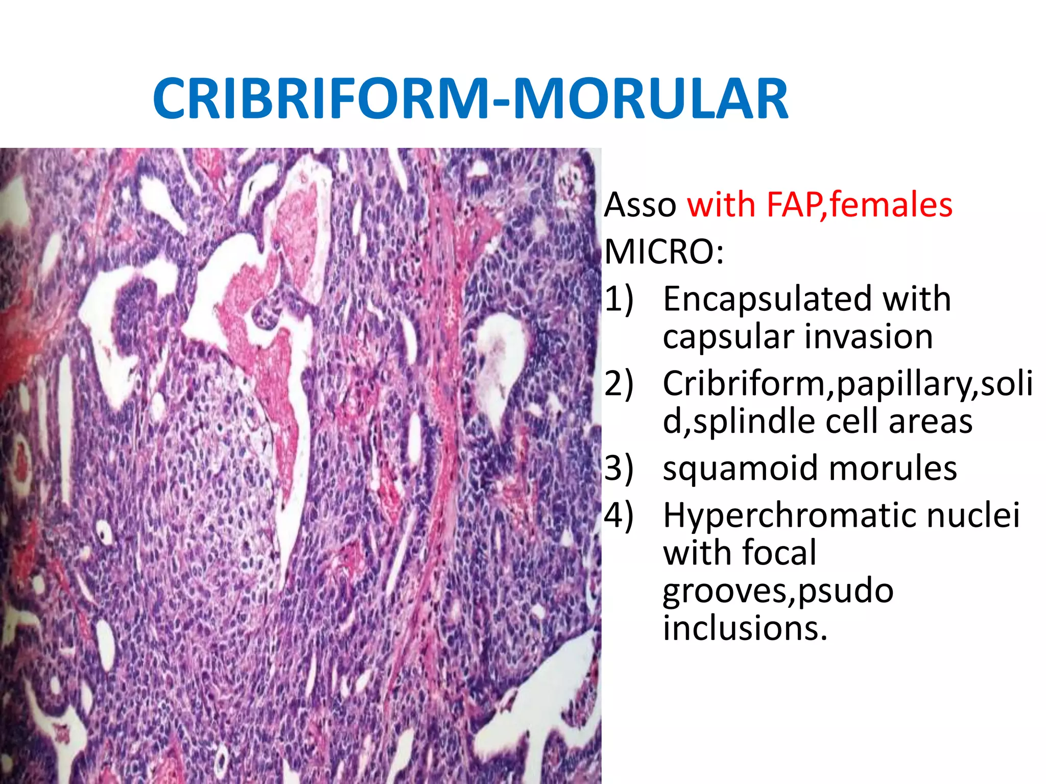 Morphological spectrum of malignant thyroid neoplasm | PPTX