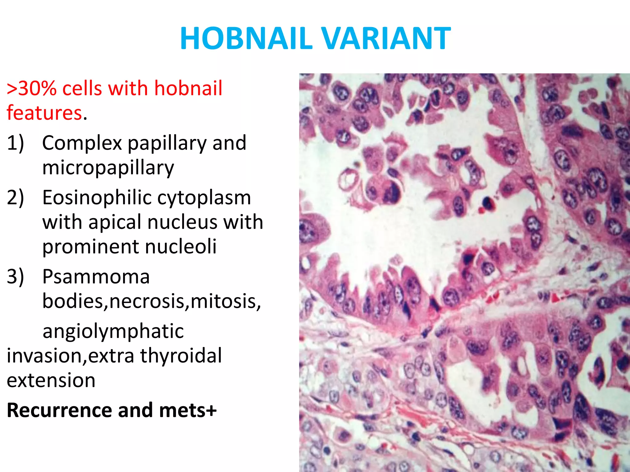 Morphological spectrum of malignant thyroid neoplasm | PPTX