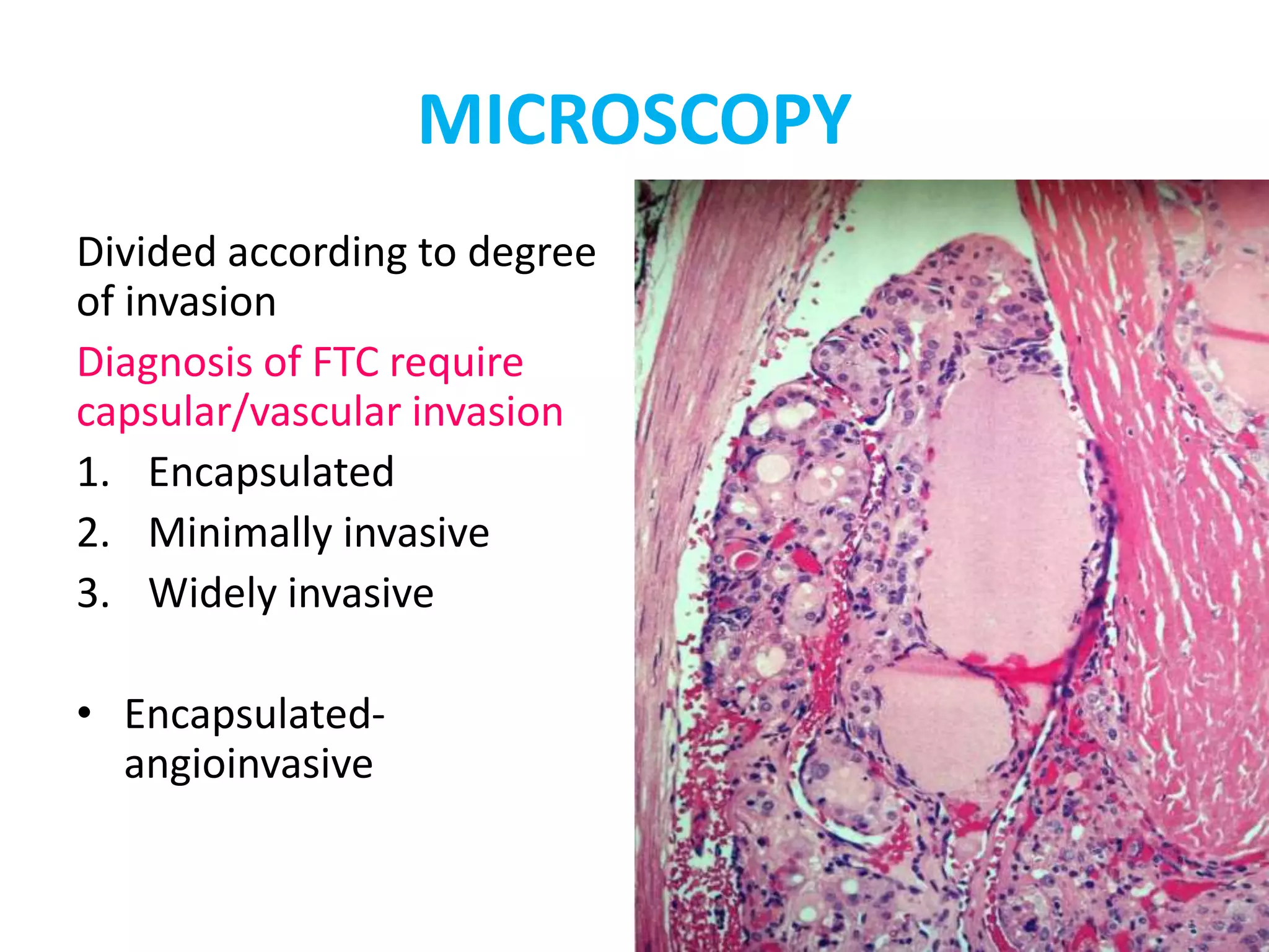 Morphological spectrum of malignant thyroid neoplasm | PPTX