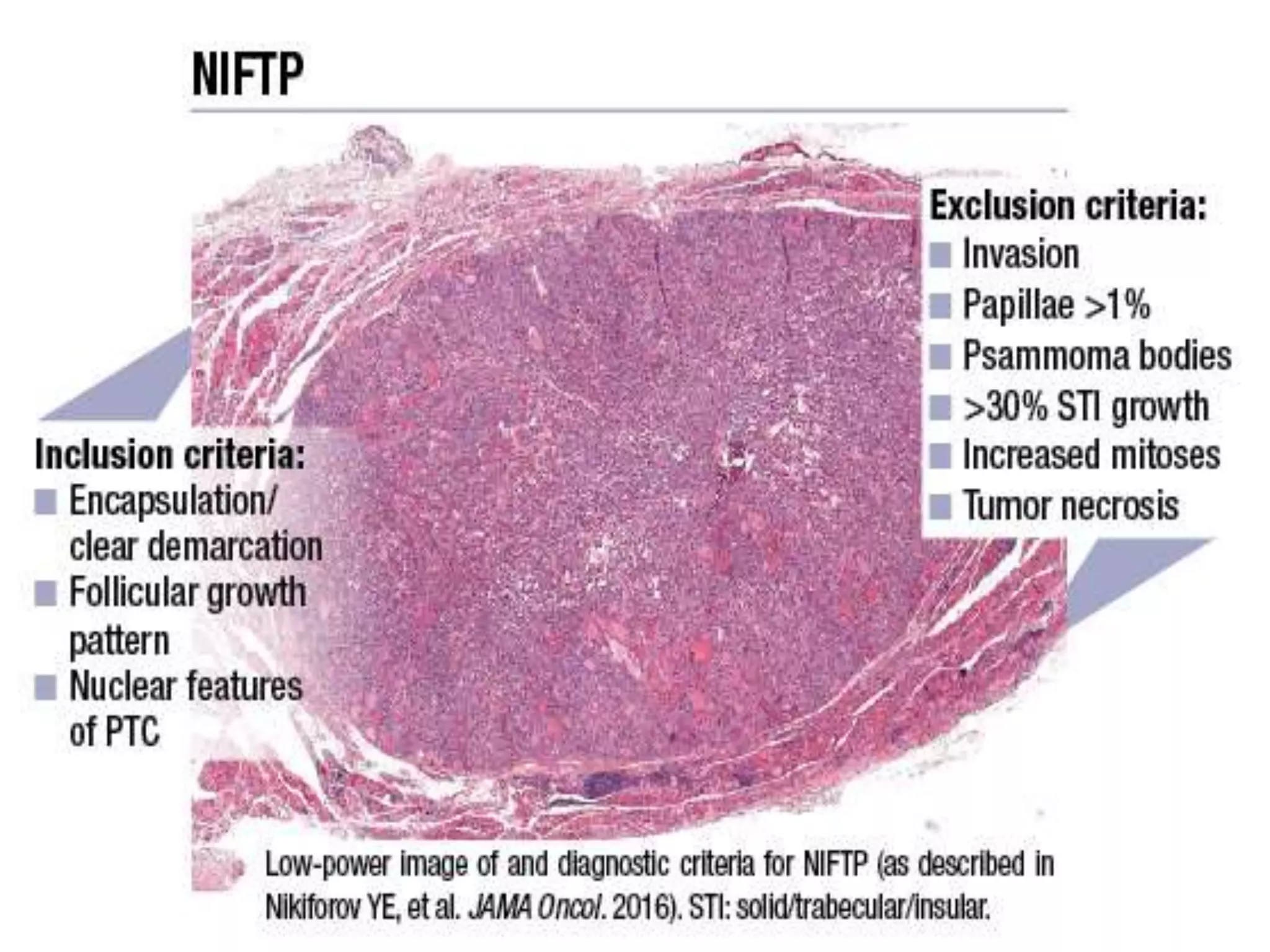 Morphological spectrum of malignant thyroid neoplasm | PPTX