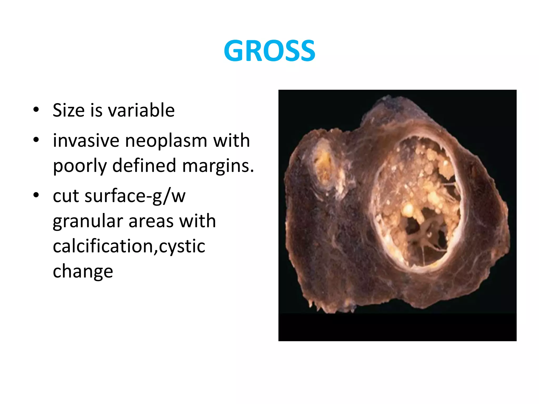 Morphological spectrum of malignant thyroid neoplasm | PPTX
