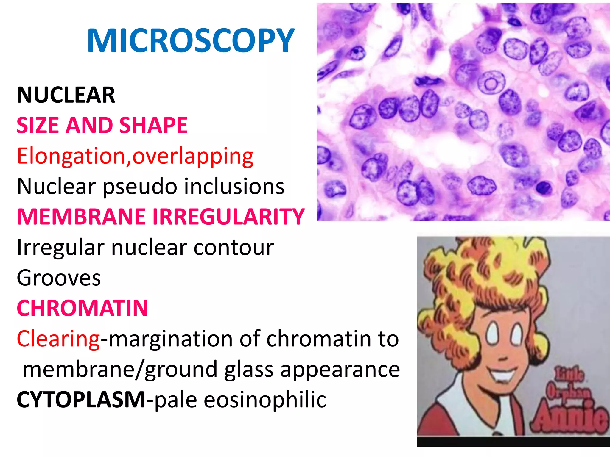 Morphological spectrum of malignant thyroid neoplasm | PPTX