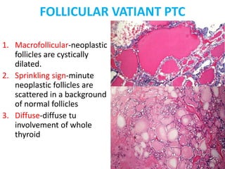 Morphological spectrum of malignant thyroid neoplasm | PPTX