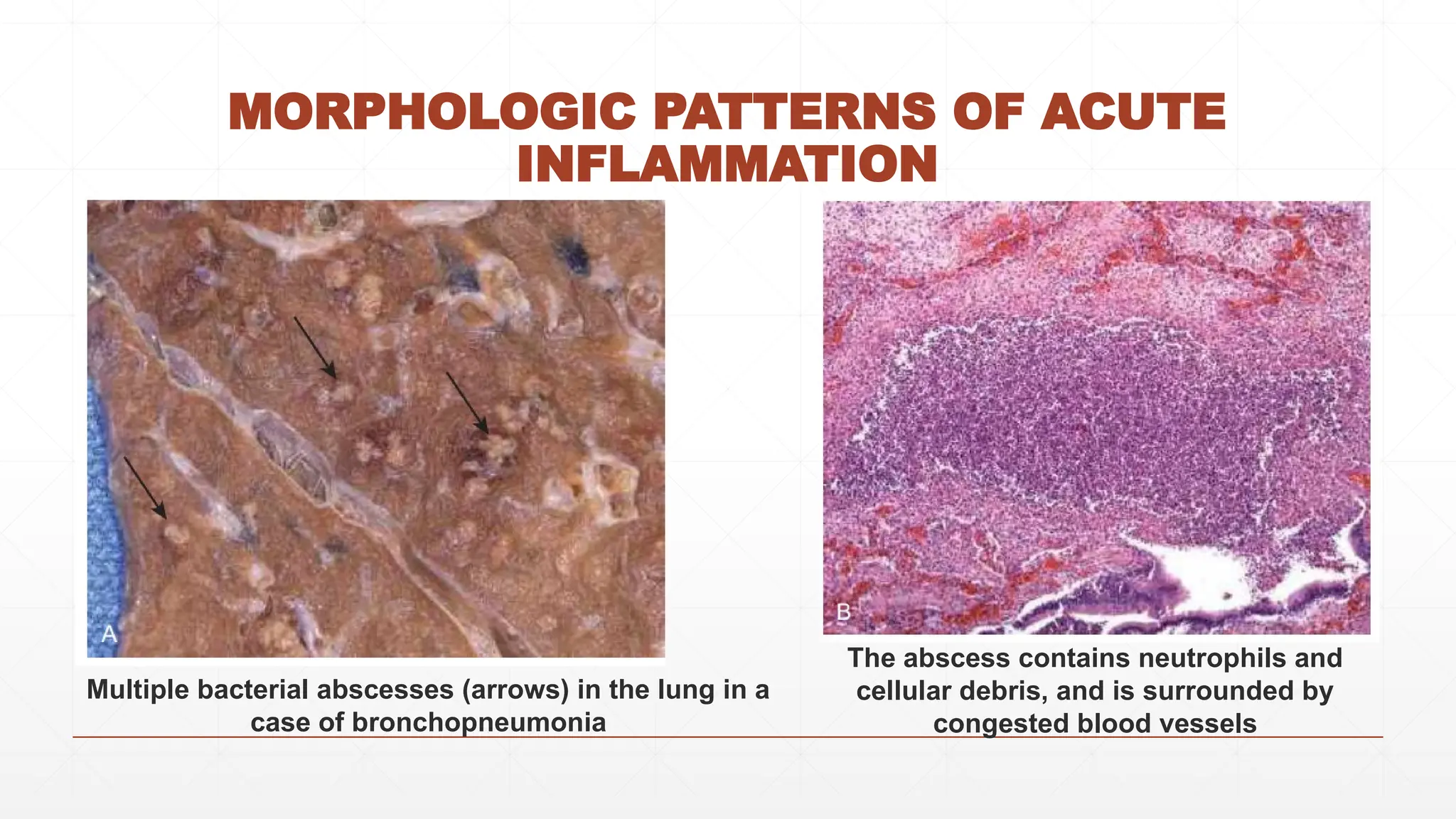 MORPHOLOGIC PATTERNS OF ACUTE INFLAMMATION.pptx