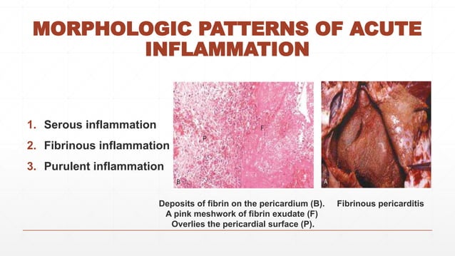 MORPHOLOGIC PATTERNS OF ACUTE INFLAMMATION.pptx