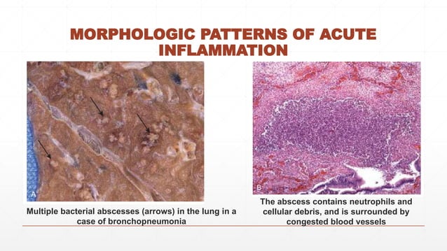 MORPHOLOGIC PATTERNS OF ACUTE INFLAMMATION.pptx