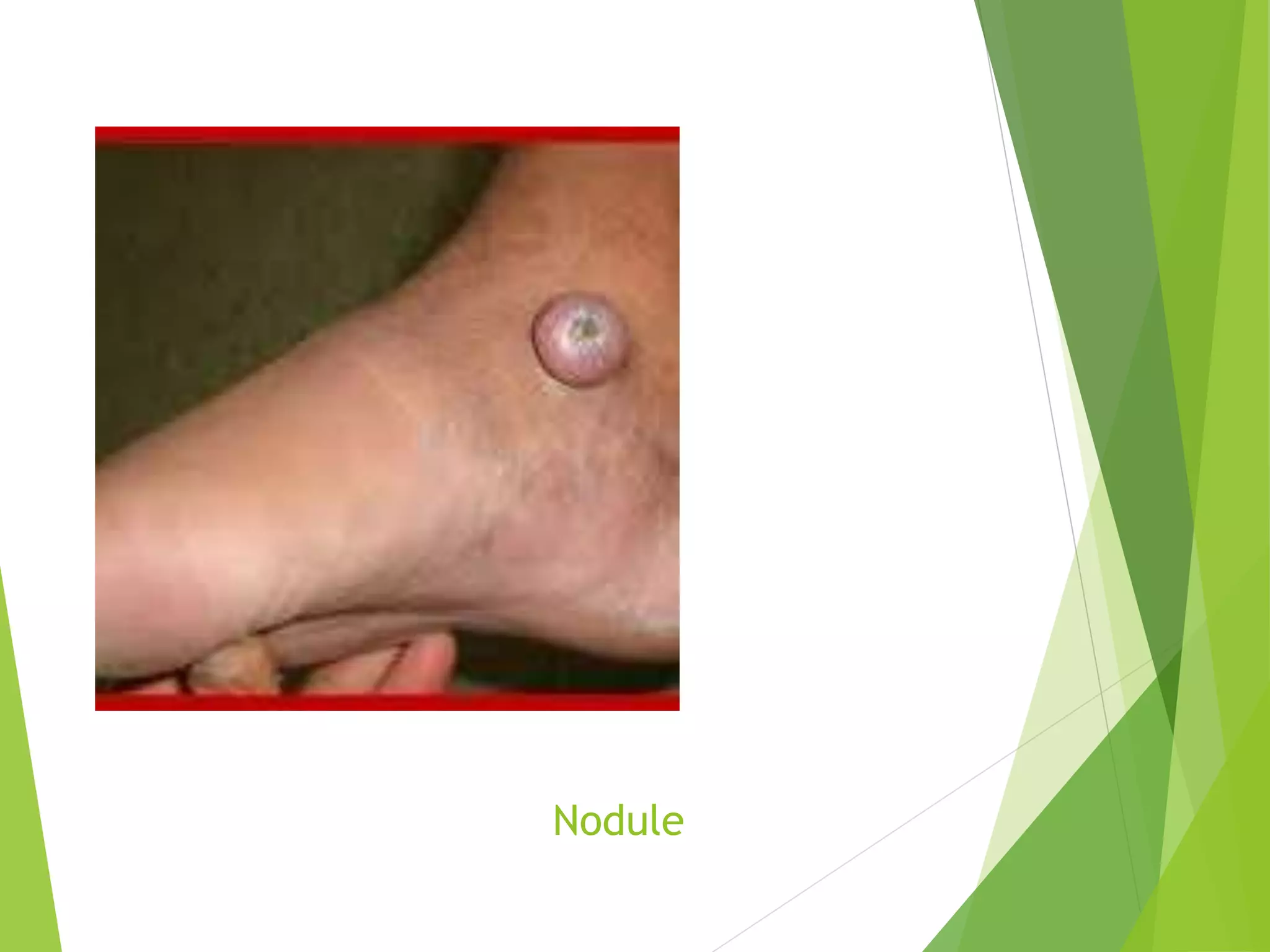 Morphologic skin lesions | PPTX