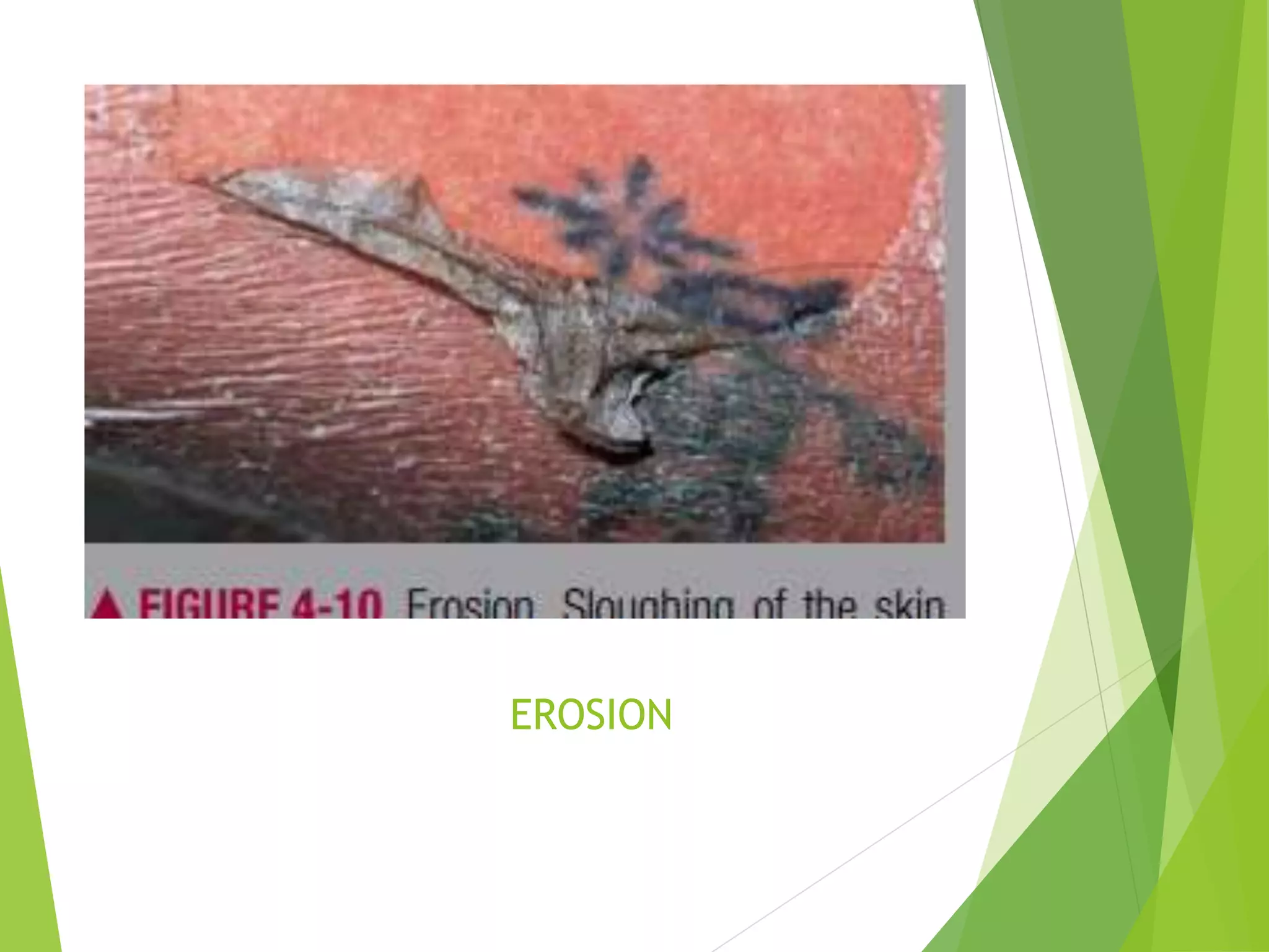 Morphologic skin lesions | PPTX